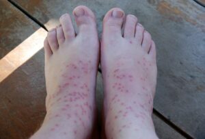 Top 6 Pictures Of Chigger Bites On Legs! | Y-L-P-C