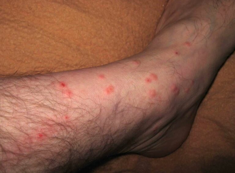 Top 10 Gnat Bites Pictures Explained! | Y-L-P-C