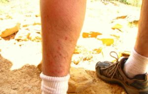 Top 10 Gnat Bites Pictures Explained! | Y-L-P-C